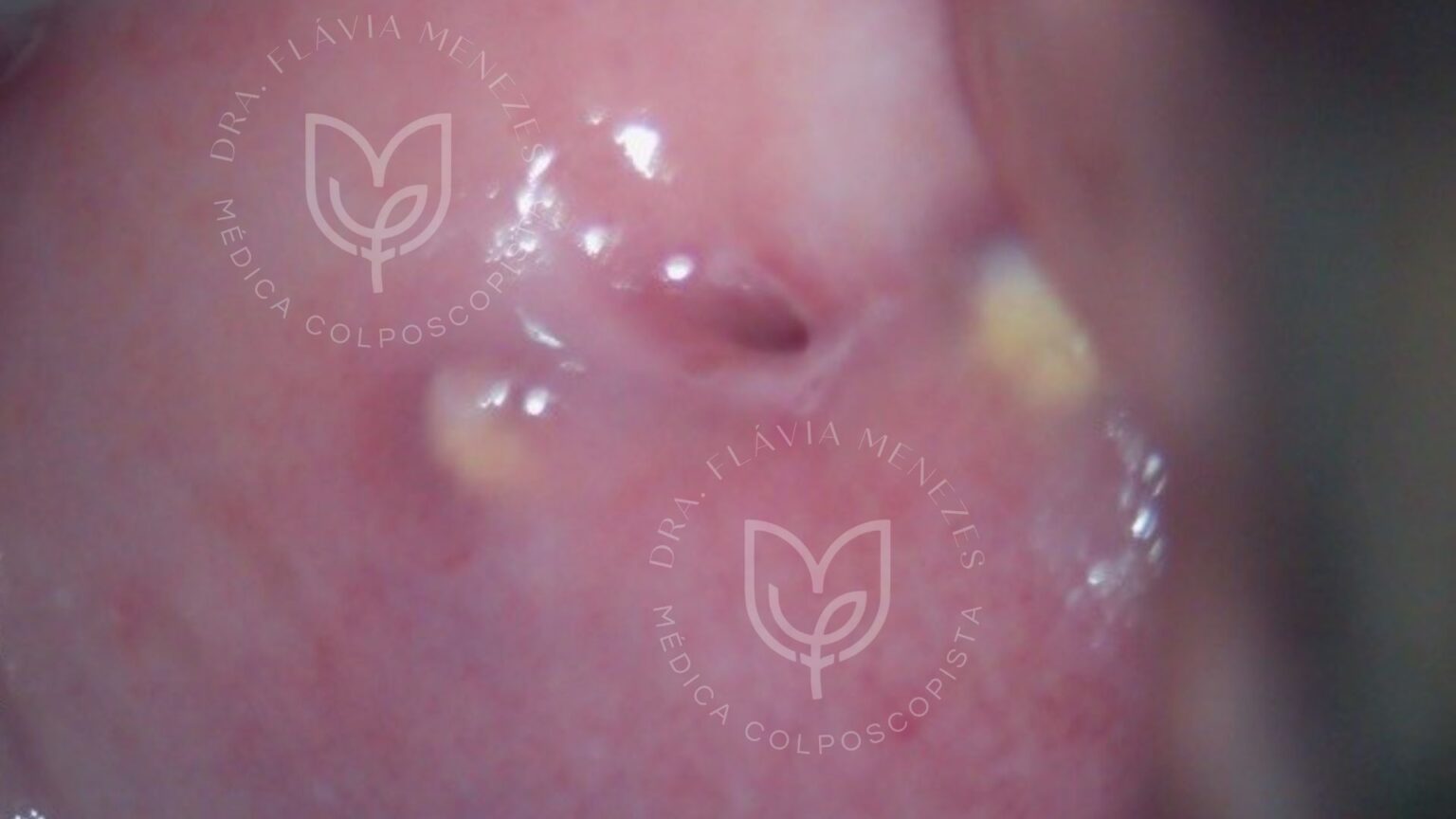 Lesão no colo do útero: - Dra. Flávia Menezes
